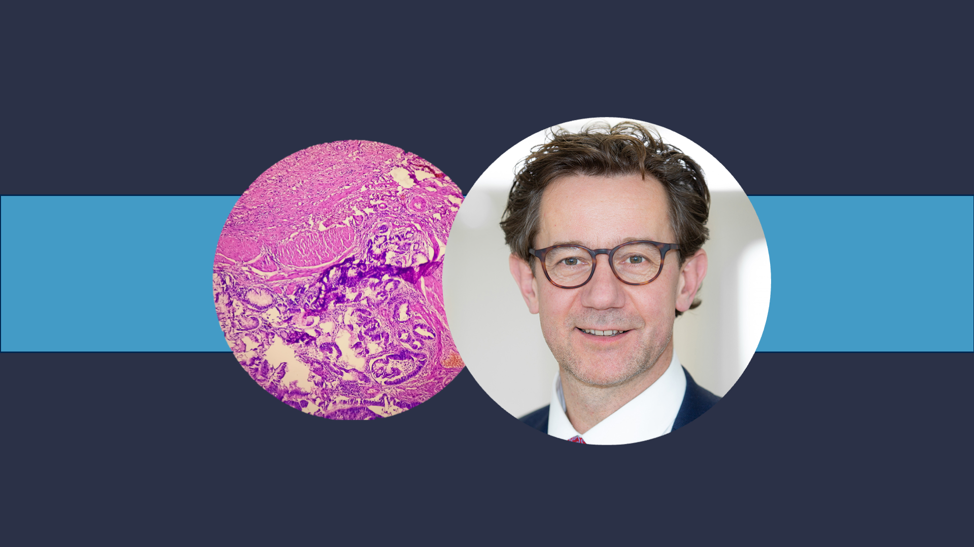 Prof. Dr. Sven Perner über die Rolle der Pathologie bei Prostatakrebs ...